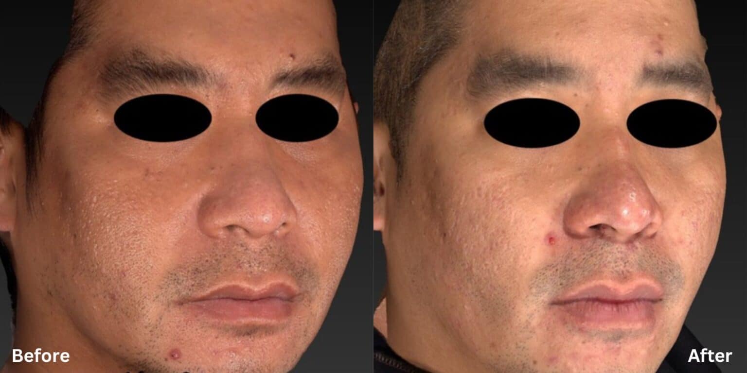 TotalSkin Solution Cleveland: RF Microneedling + Laser Resurfacing