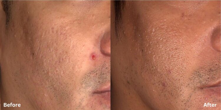 TotalSkin Solution Cleveland: RF Microneedling + Laser Resurfacing