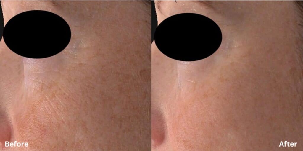 TotalSkin Solution Cleveland: RF Microneedling + Laser Resurfacing