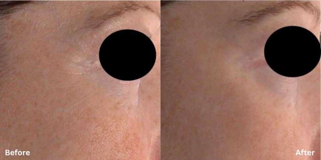 TotalSkin Solution Cleveland: RF Microneedling + Laser Resurfacing