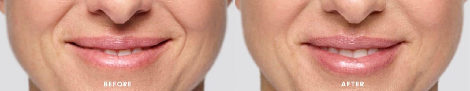 Lip Filler Cleveland | Lip Augmentation Strongsville