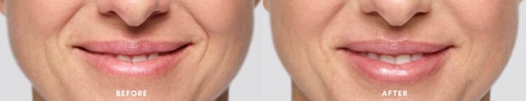 Lip Filler Cleveland | Lip Augmentation Strongsville